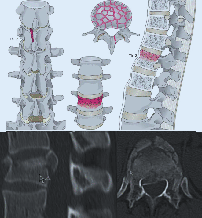 Die neue AOSpine-Klassifikation: Alles einfacher? | SpringerLink