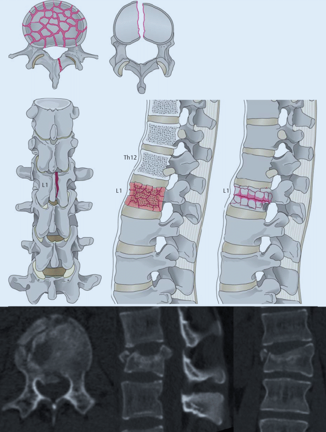Die neue AOSpine-Klassifikation: Alles einfacher? | SpringerLink