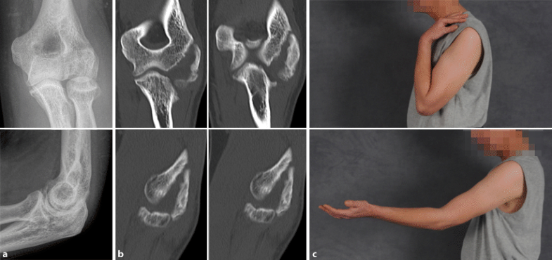 Steifer posttraumatischer Ellenbogen | SpringerLink