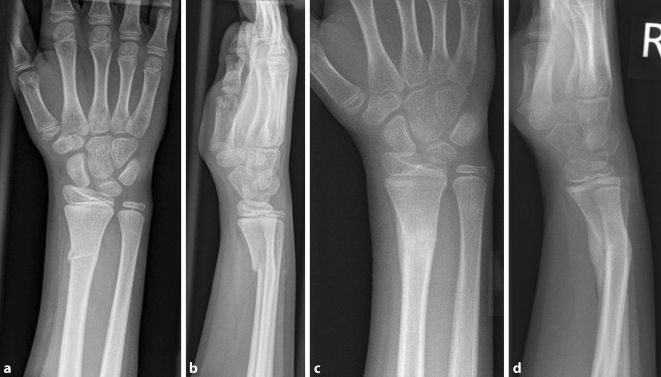 Behandlung der kindlichen Unterarmschaftfraktur | SpringerLink