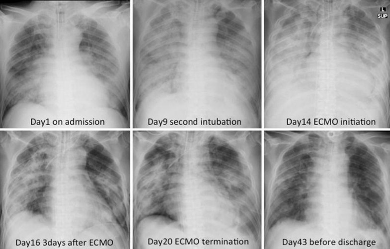 Acute respiratory distress syndrome (ARDS) treated successfully by veno ...
