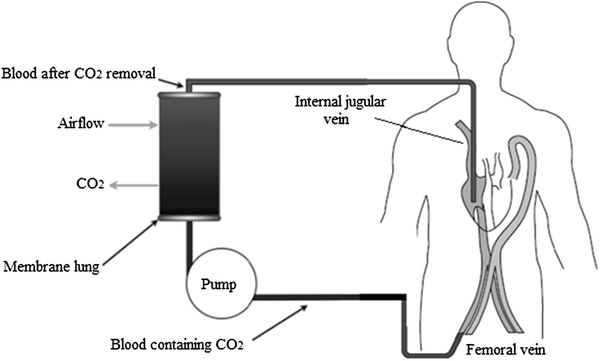 Extracorporeal carbon dioxide removal (ECCO2R) in respiratory ...