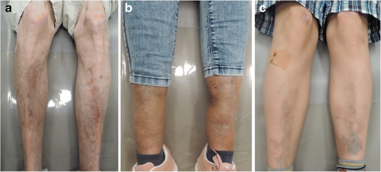 Periodontal Ehlers–Danlos syndrome is associated with ...