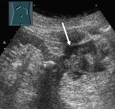 Abdomineller Ultraschall | SpringerLink