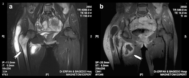 Bone marrow edema syndromes of the hip: MRI features in different hip ...