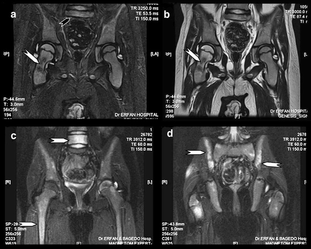 Bone marrow edema syndromes of the hip: MRI features in different hip ...