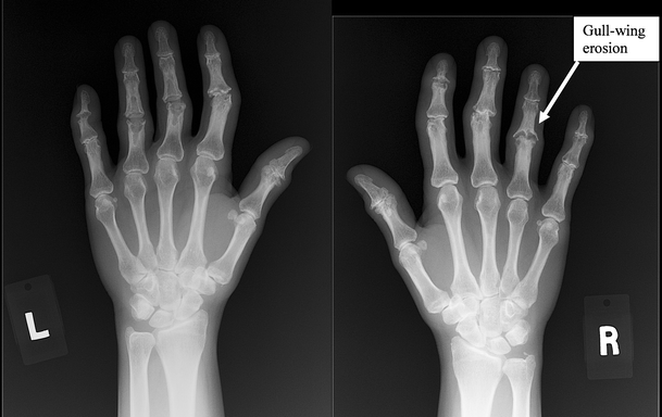 Erosive osteoarthritis: a current review of a clinical challenge ...