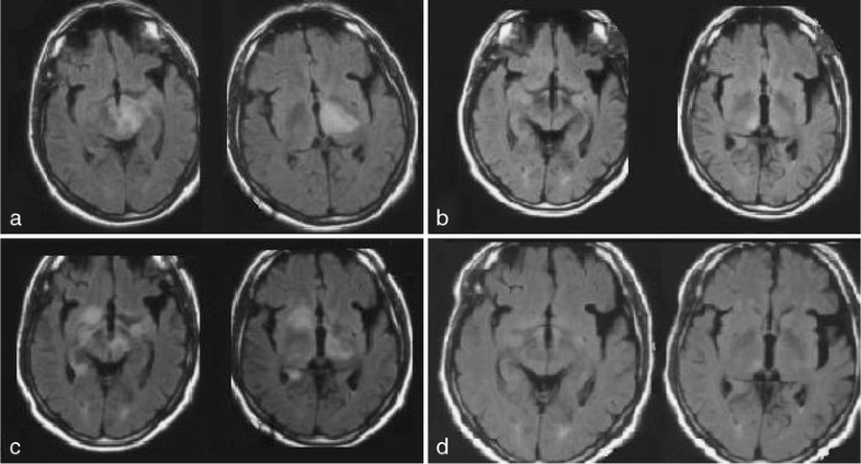 MRI findings of neuro-Behcet’s disease | SpringerLink