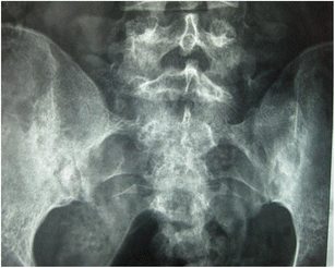 Enthesitis-related arthritis | SpringerLink