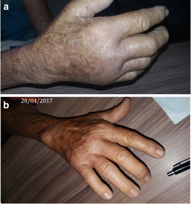 Management of chikungunya arthritis | SpringerLink