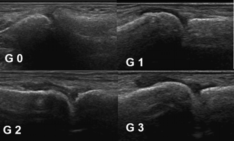 Subclinical synovitis and enthesitis in psoriasis patients and controls ...