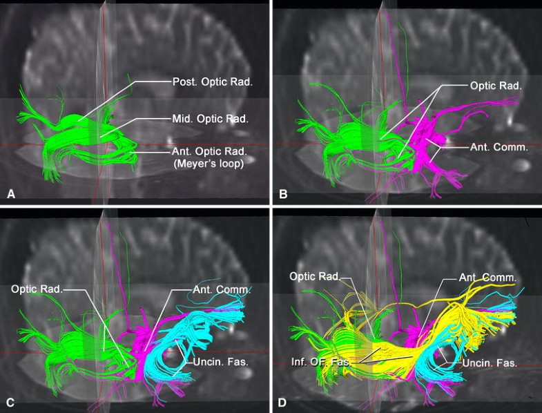 Microsurgical and tractographic anatomical study of insular and ...