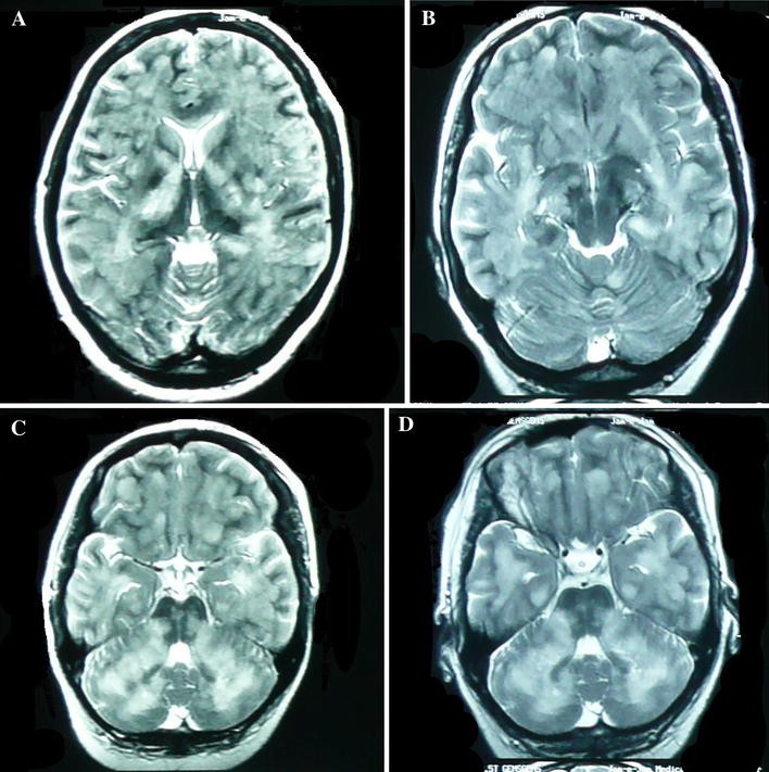 Fulminant multiple sclerosis (MS) | SpringerLink