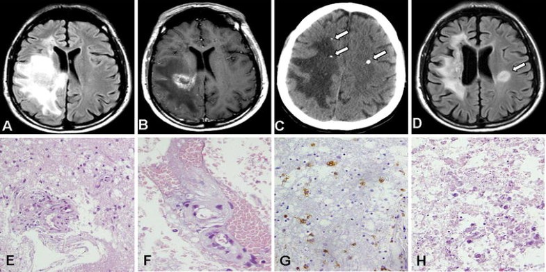 TREX1 C-terminal frameshift mutations in the systemic variant of ...