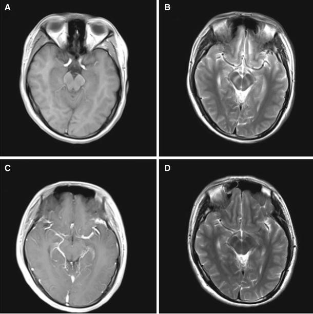 Postencephalitic parkinsonism and selective involvement of substantia ...