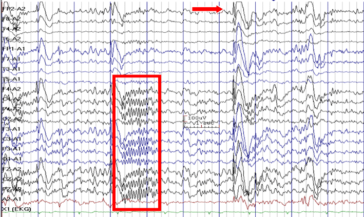 Lennox-Gastaut syndrome: a comprehensive review | SpringerLink
