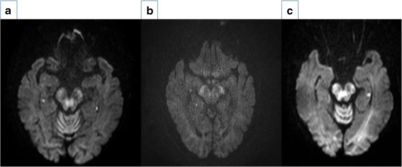 Unilateral or bilateral punctate hippocampal hyperintensities on DW-MRI ...