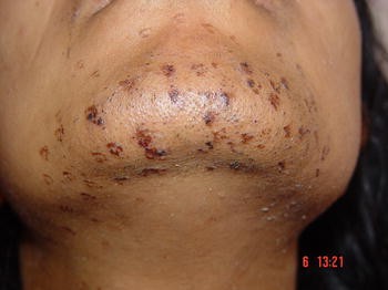 A review of the adverse effects of laser hair removal | SpringerLink