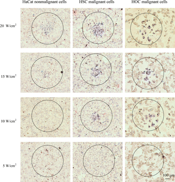 Plasmonic photothermal therapy (PPTT) using gold nanoparticles ...