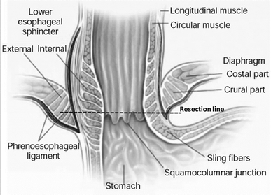 Clinical outcome of lower esophageal sphincter- and vagus-nerve ...