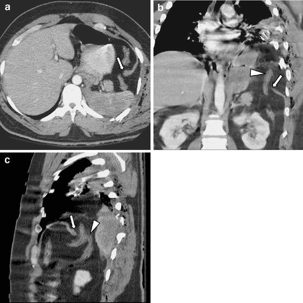Diaphragmatic rupture: a frequently missed injury in blunt ...