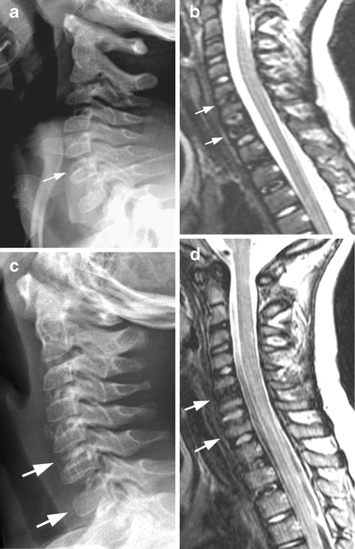 Calcific discitis in children: vertebral body involvement (possible ...