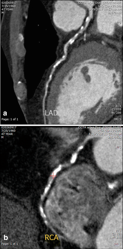 Cardiovascular complications of cocaine: Imaging findings | SpringerLink
