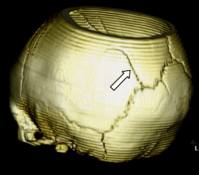 Skull fracture vs. accessory sutures: how can we tell the difference ...
