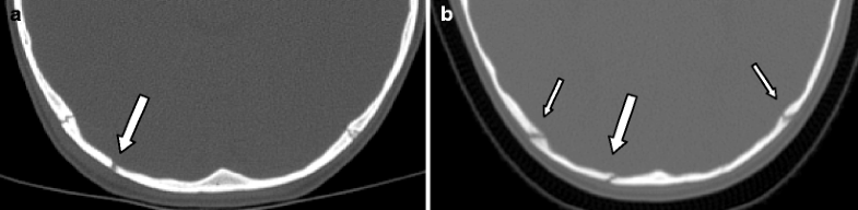 Skull fracture vs. accessory sutures: how can we tell the difference ...