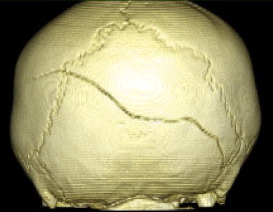 Skull fracture vs. accessory sutures: how can we tell the difference ...