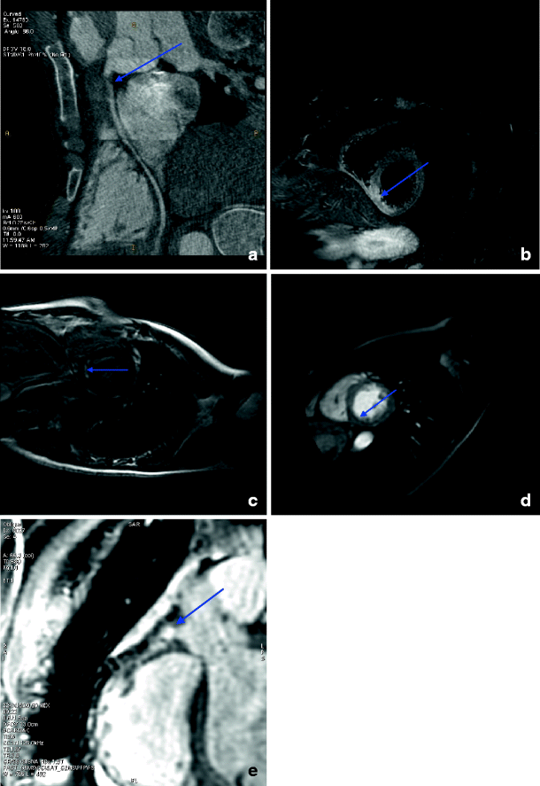 Myocardial infarction after blunt chest trauma: usefulness of cardiac ...