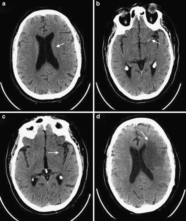 Caudate body (CB) sign: New early CT sign of hyperacute anterior ...