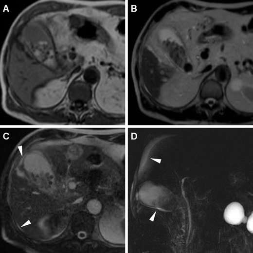 Urgent MRI with MR cholangiopancreatography (MRCP) of acute ...