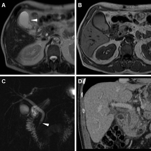 Urgent MRI with MR cholangiopancreatography (MRCP) of acute ...