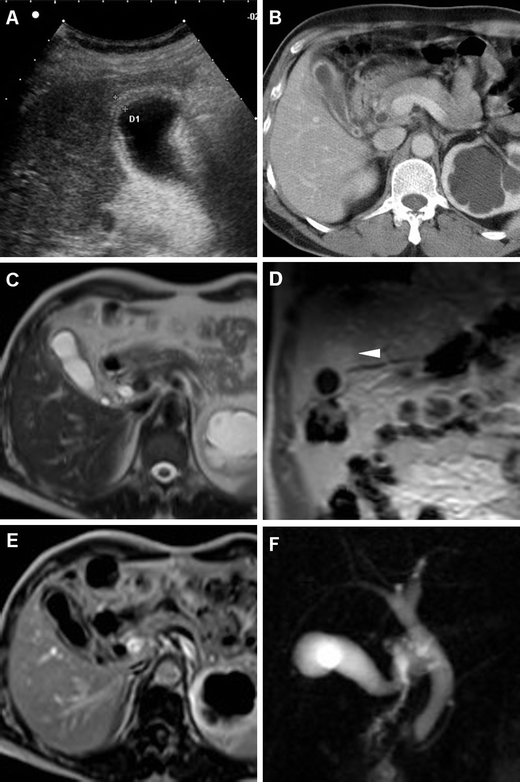 Urgent MRI with MR cholangiopancreatography (MRCP) of acute ...