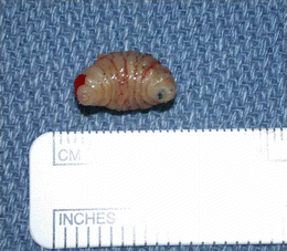 Human botfly ( Dermatobia hominis) larva in a child’s scalp mimicking ...