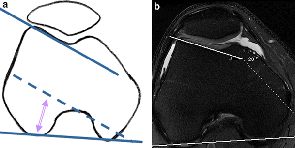 Transient lateral patellar dislocation: review of imaging findings ...