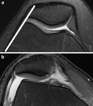 Transient lateral patellar dislocation: review of imaging findings ...