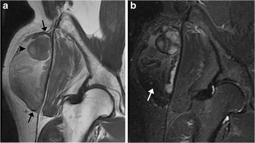 The Morel-Lavallée lesion: pathophysiology, clinical presentation ...
