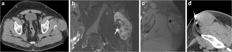 The Morel-Lavallée lesion: pathophysiology, clinical presentation ...