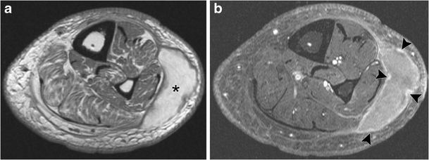 The Morel-Lavallée lesion: pathophysiology, clinical presentation ...