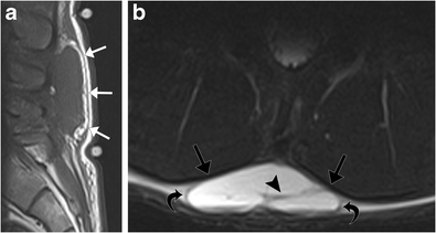 The Morel-Lavallée lesion: pathophysiology, clinical presentation ...