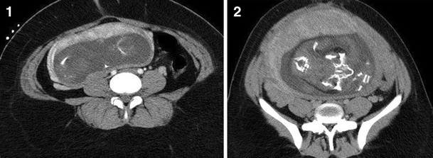 Traumatic Abruptio Placenta Scale (TAPS): a proposed grading system of ...