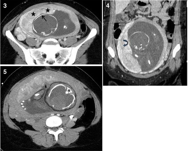 Traumatic Abruptio Placenta Scale (TAPS): a proposed grading system of ...