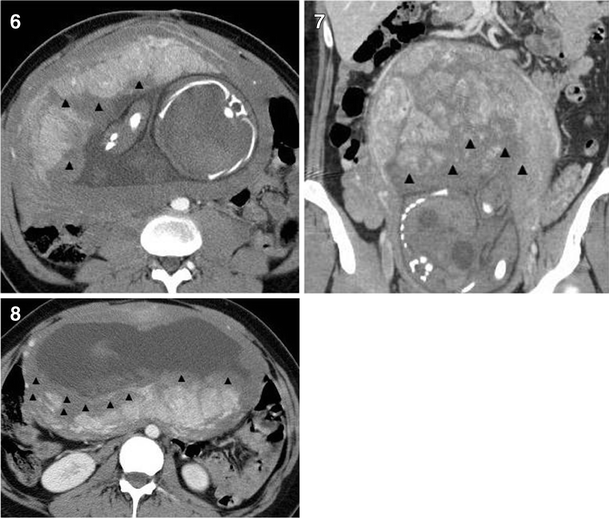 Traumatic Abruptio Placenta Scale (TAPS): a proposed grading system of ...