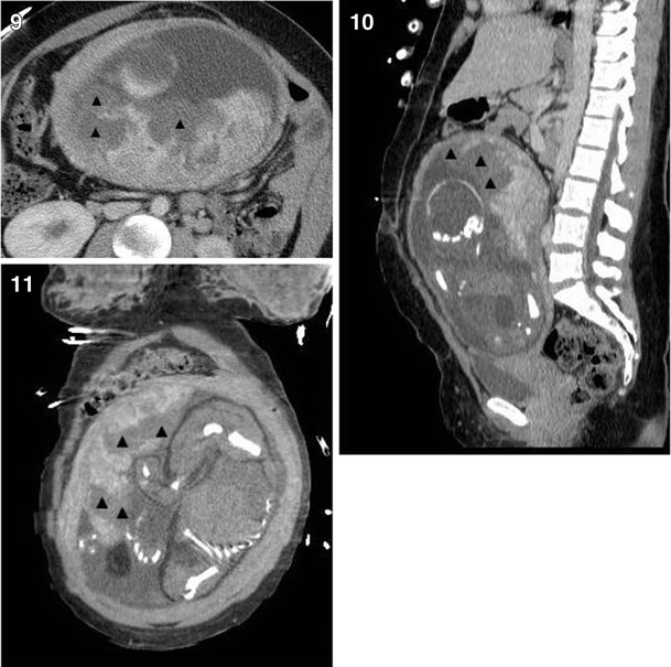 Traumatic Abruptio Placenta Scale (TAPS): a proposed grading system of ...
