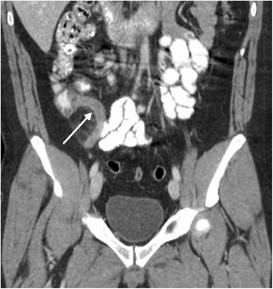 Stump appendicitis: surgical background, CT appearance, and imaging ...