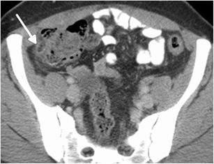 Stump appendicitis: surgical background, CT appearance, and imaging ...