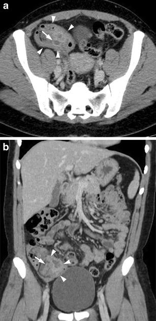 Inflammatory appendix mass in patients with acute appendicitis: CT ...
