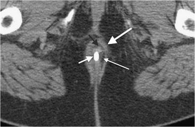 CT of acute perianal abscesses and infected fistulae: a pictorial essay ...